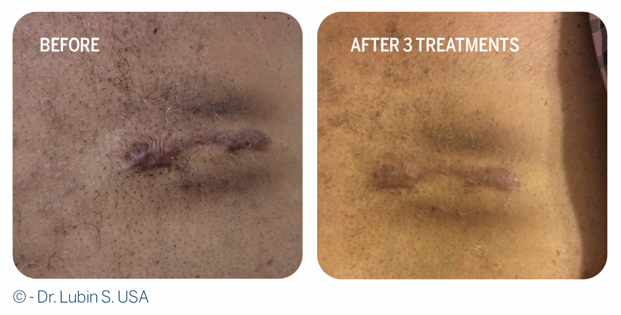 ACNE & KELOID SCARS | Regen Lab